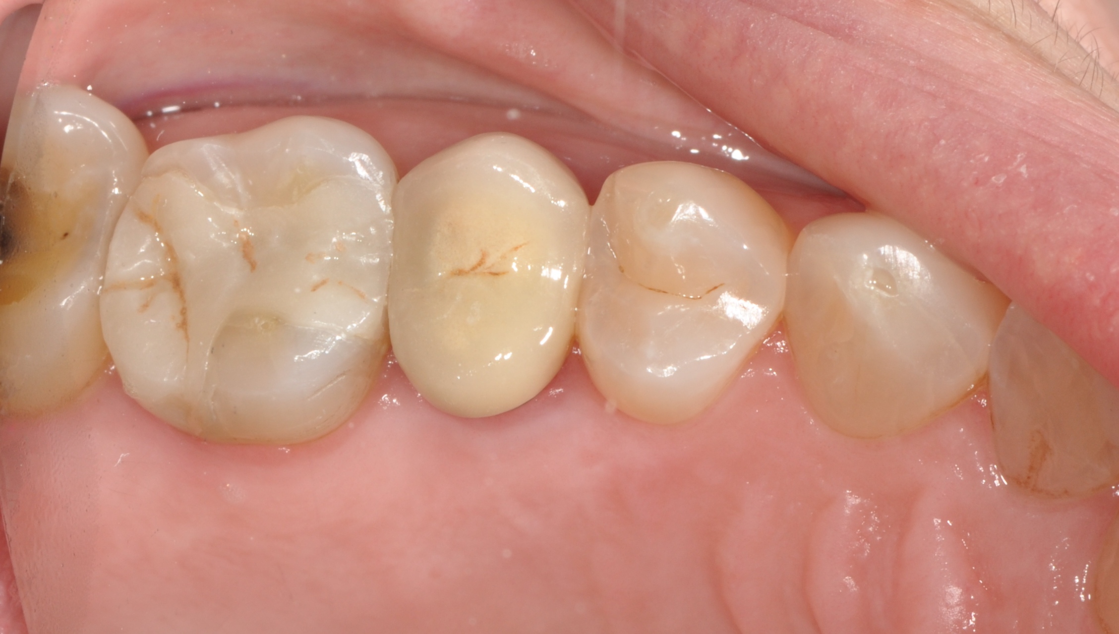 Inlay core ou faux moignon.Dans quels cas est il indispensable ...