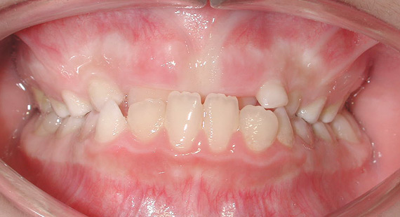 Tous les troubles de l'occlusion dentaire-Surocclusion,sous occlusion ...