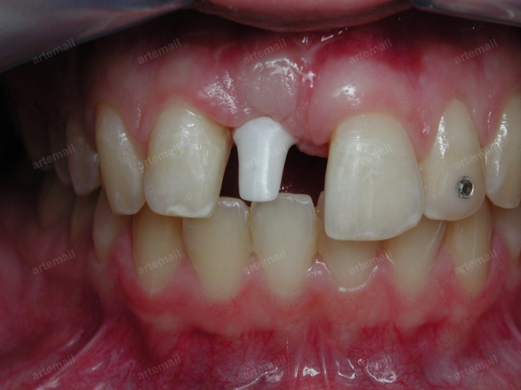 INLAY CORE ou FAUX MOIGNON - LABORATOIRE MEDIDENT