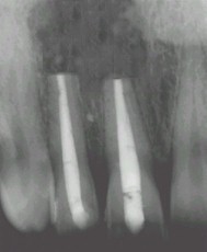 La résection apicale,c'est quoi exactement?Laboratoire Medident